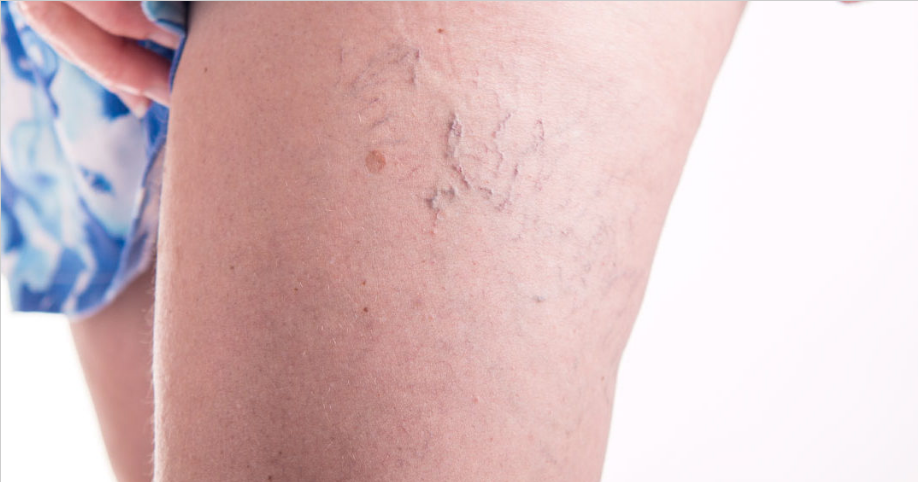 Cancer of the veins on the rise since COVID-19 pandemic – MEZIESBLOG