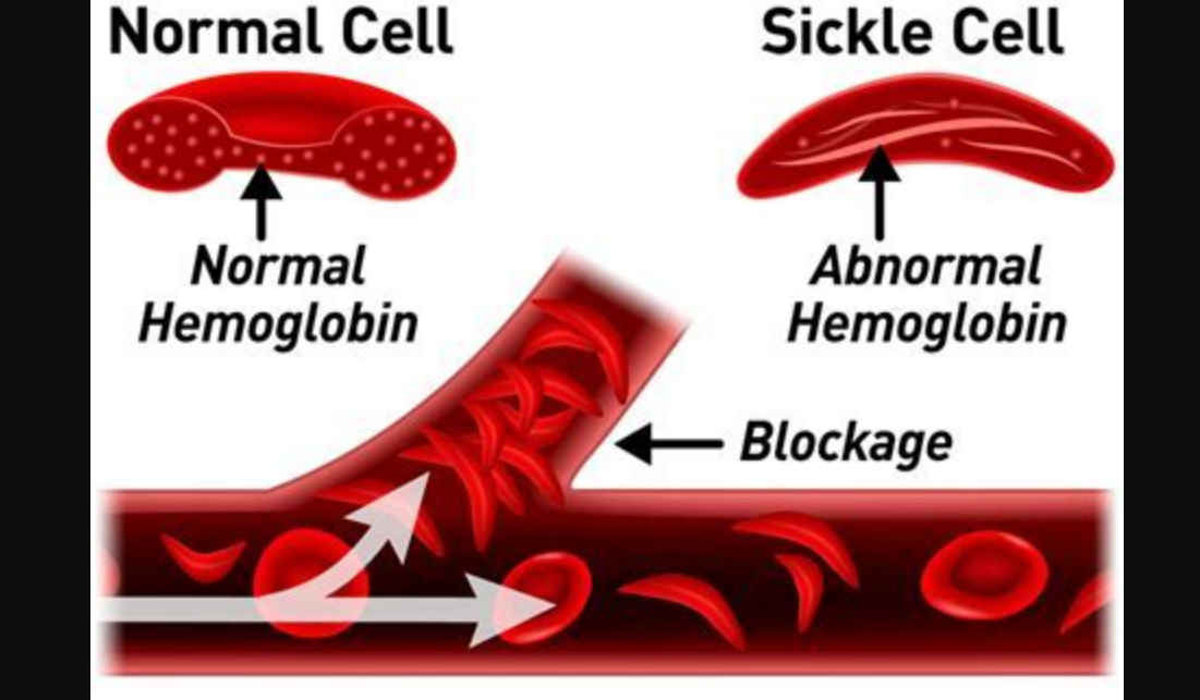LOVE STORY: Woman shares painful experience with sickle cell – MEZIESBLOG